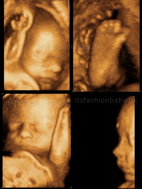 Anmeldelse af 3D scanning hos Ultralydklinikken for Gravide